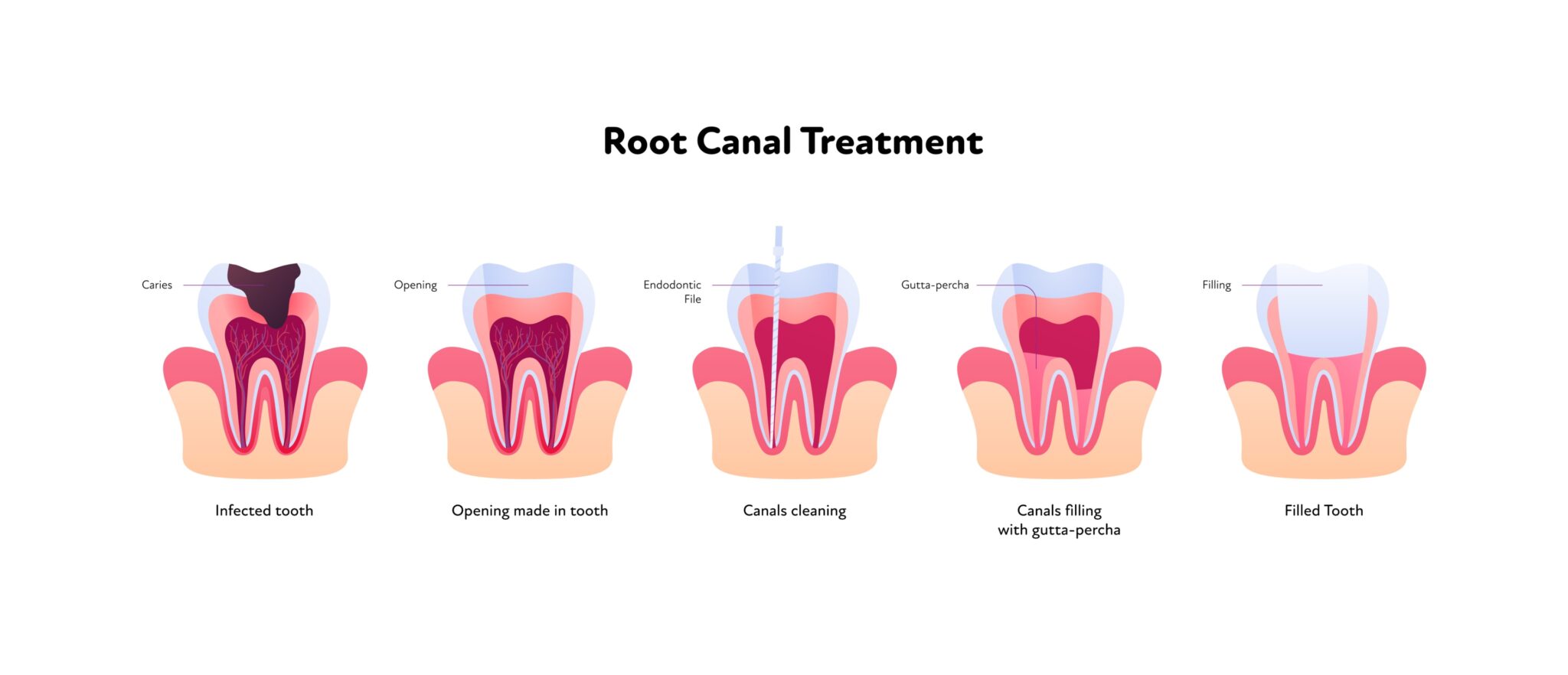 Understanding Root Canal Treatment: Procedure, Benefits & Recovery ...