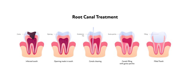Understanding Root Canal Treatment: Procedure, Benefits & Recovery ...