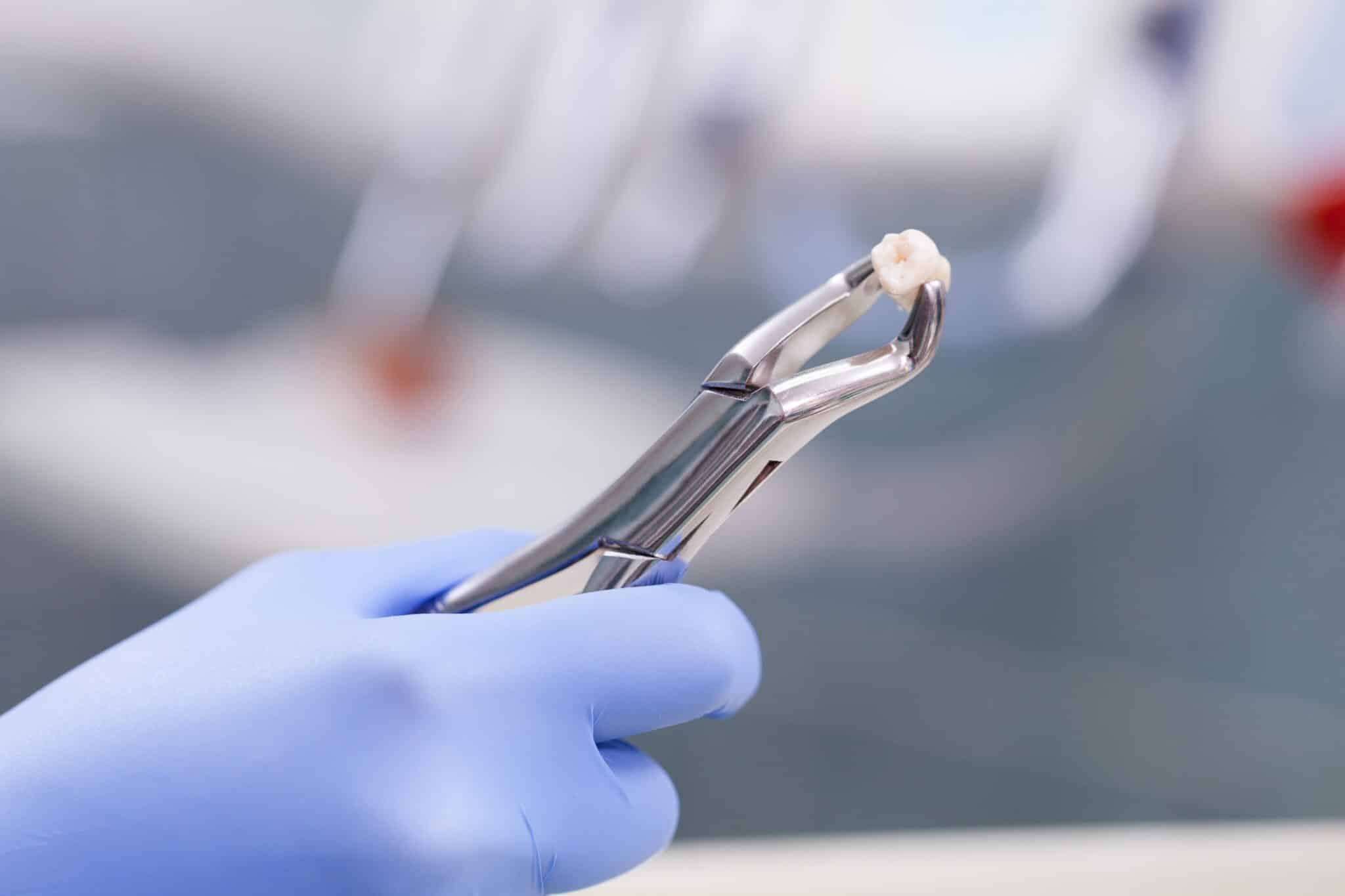 Tooth Extractions in Yorktown: When Is a Surgical Extraction Necessary ...